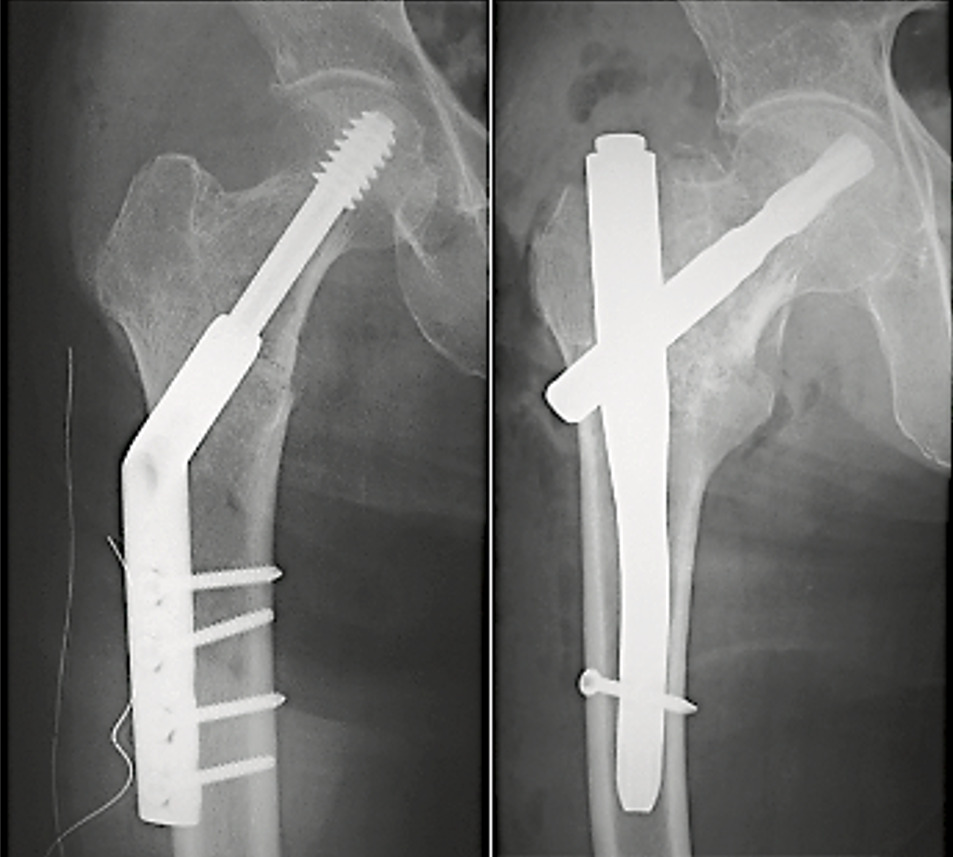 大腿骨近位部骨折｜基礎編 - リハスタ